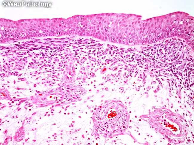 Botryoid Rhabdomyosarcoma
