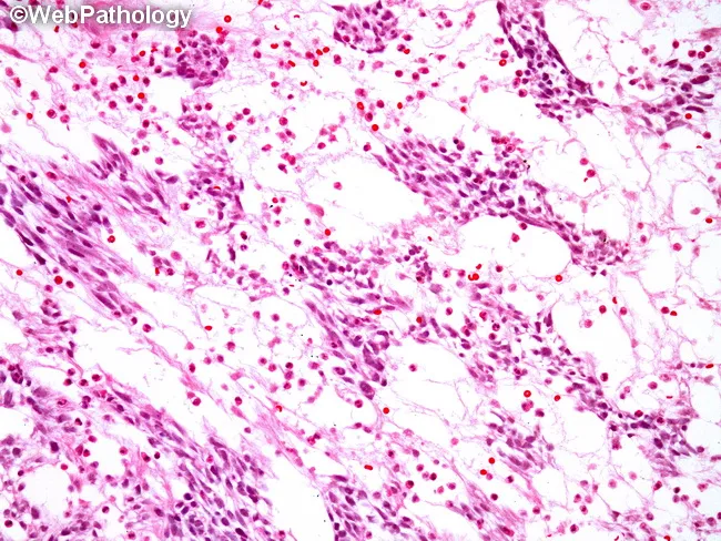 Botryoid Rhabdomyosarcoma