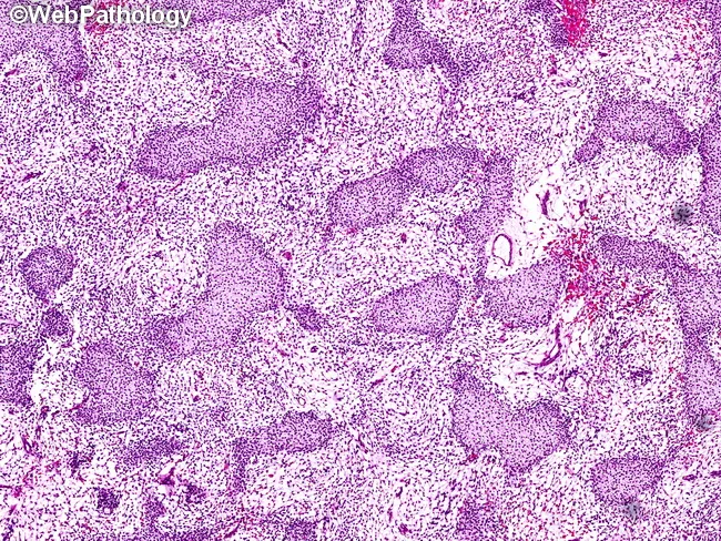 Botryoid Rhabdomyosarcoma