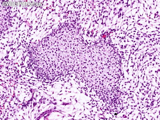 Botryoid Rhabdomyosarcoma