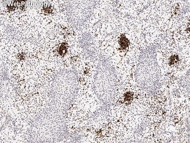 Botryoid Rhabdomyosarcoma : Desmin