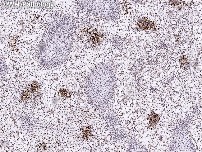Botryoid Rhabdomyosarcoma : Myogenin