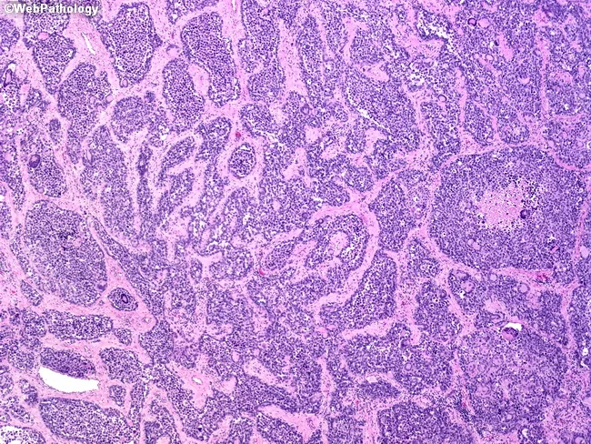 Alveolar Rhabdomyosarcoma : Microscopic