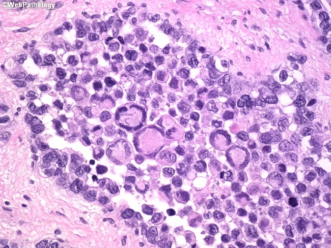 Alveolar Rhabdomyosarcoma : Microscopic