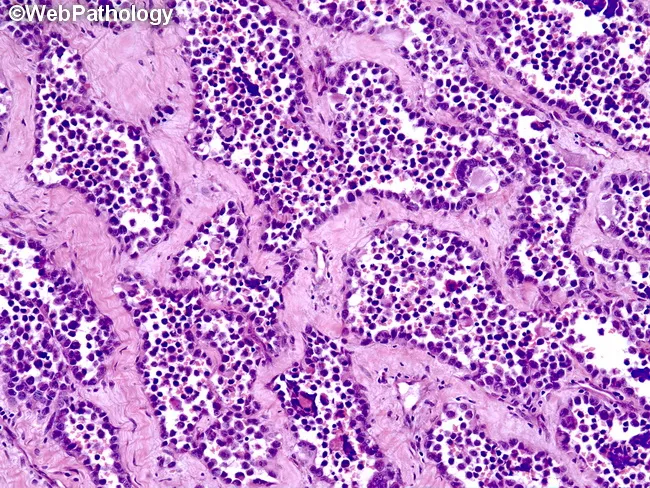 Alveolar Rhabdomyosarcoma : Microscopic