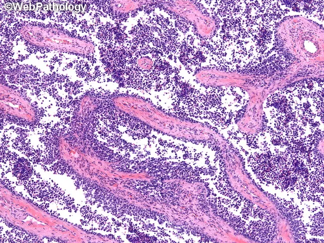 Alveolar Rhabdomyosarcoma : Microscopic