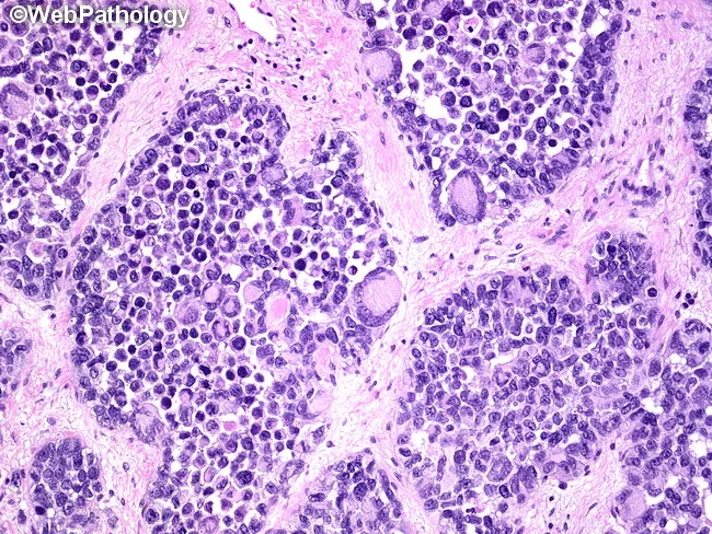 Alveolar Rhabdomyosarcoma