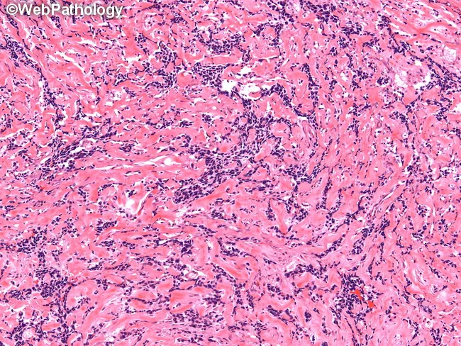Alveolar Rhabdomyosarcoma