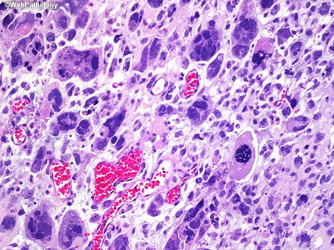 Pleomorphic Rhabdomyosarcoma : Microscopic