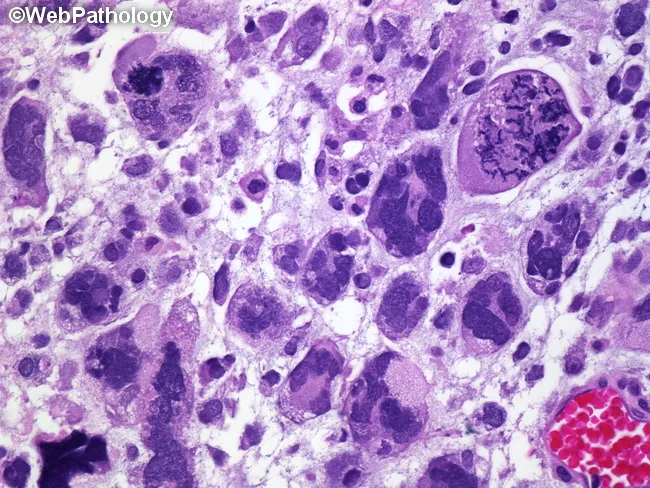 Pleomorphic Rhabdomyosarcoma : Microscopic