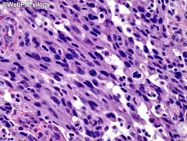 Pleomorphic Rhabdomyosarcoma : Prognosis