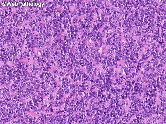 Spindle Cell/Sclerosing Rhabdomyosarcoma