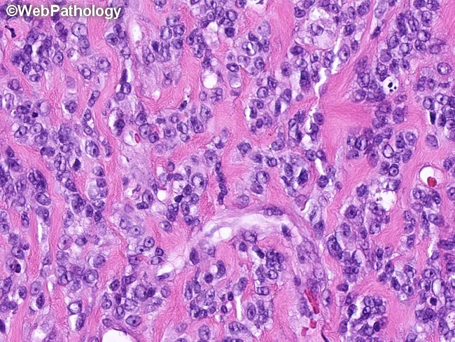 Spindle Cell/Sclerosing Rhabdomyosarcoma : Molecular Genetics
