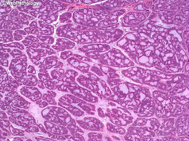 Pleomorphic Adenoma Pathology Pleomorphic Adenoma: Parotid Gland