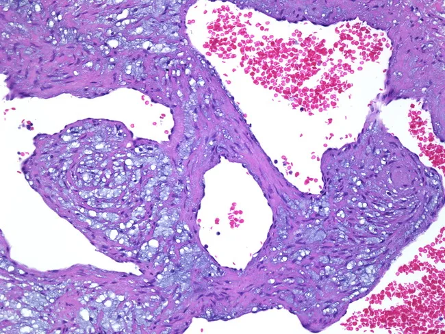 Arteriovenous Malformation Pathology Outlines