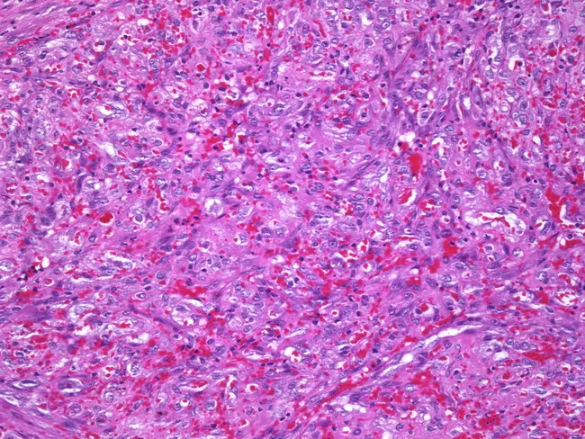 Bacillary Angiomatosis