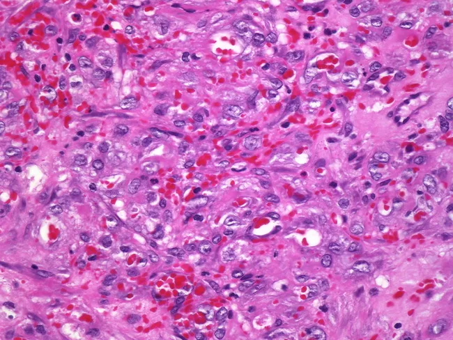 Bacillary Angiomatosis