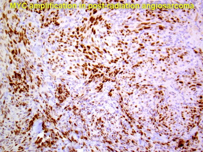 Angiosarcoma : Molecular Genetics