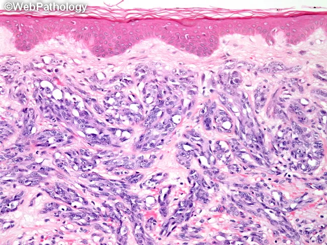 Cutaneous Angiosarcoma