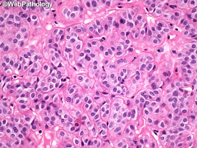 Cellular Pleomorphic Adenoma