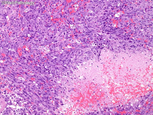 Angiosarcoma : Grading