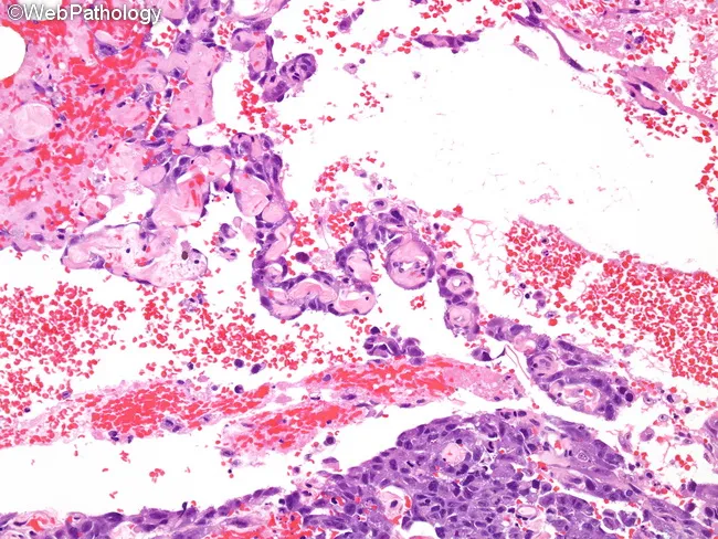 Cutaneous Angiosarcoma : Prognosis