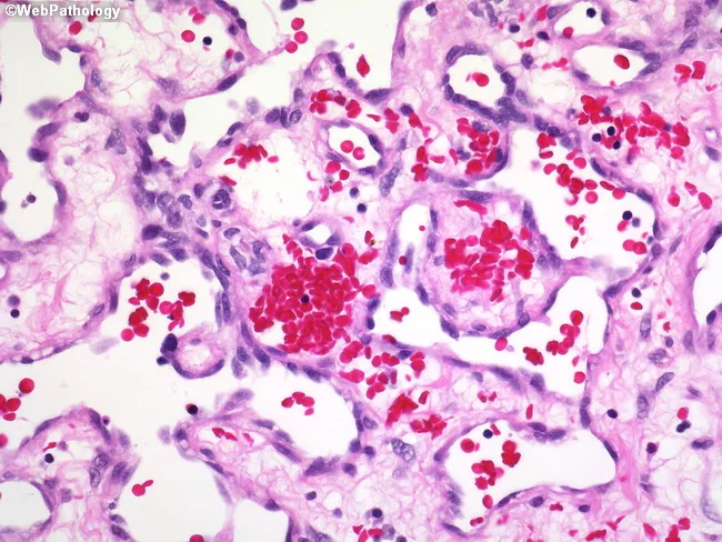 Lymphedema-associated Angiosarcoma
