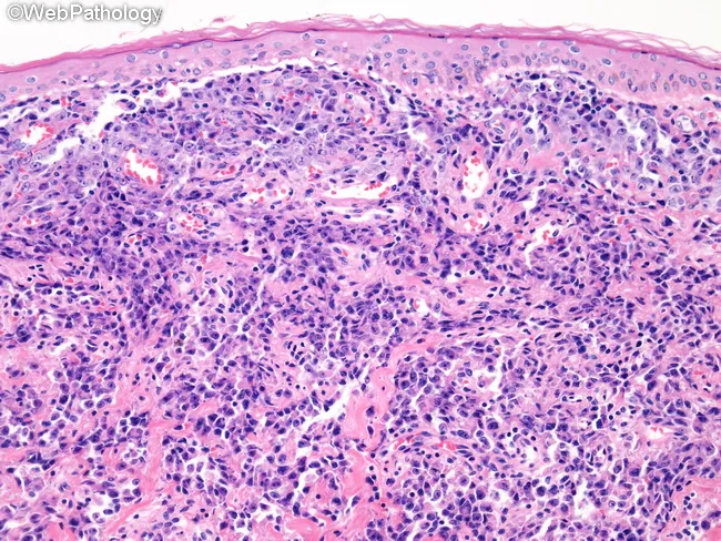 Post-radiation Angiosarcoma