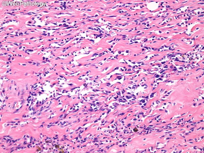 Post-radiation Angiosarcoma