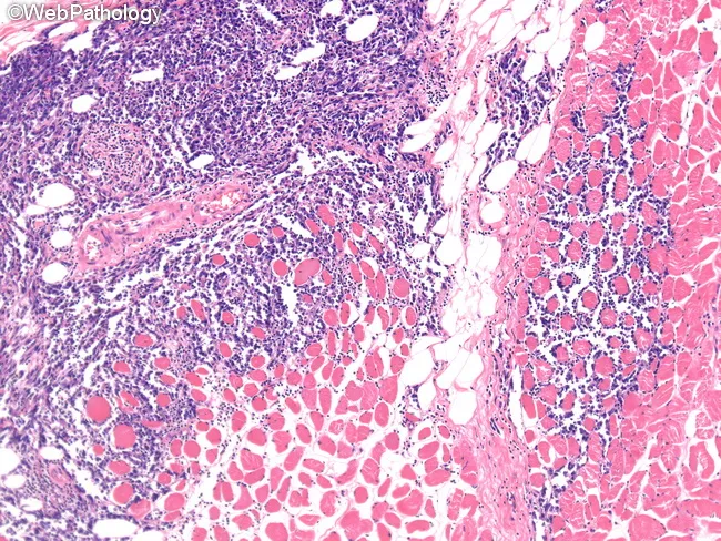 Post-radiation Angiosarcoma