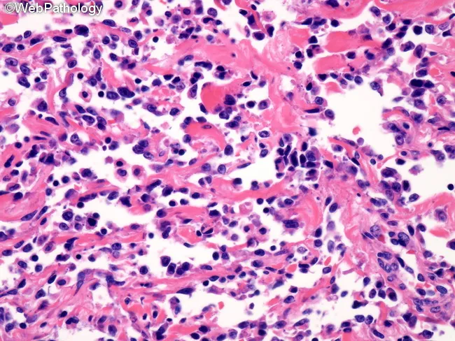 Post-radiation Angiosarcoma