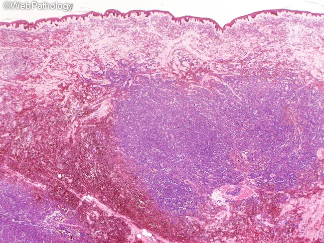 Post-radiation Angiosarcoma