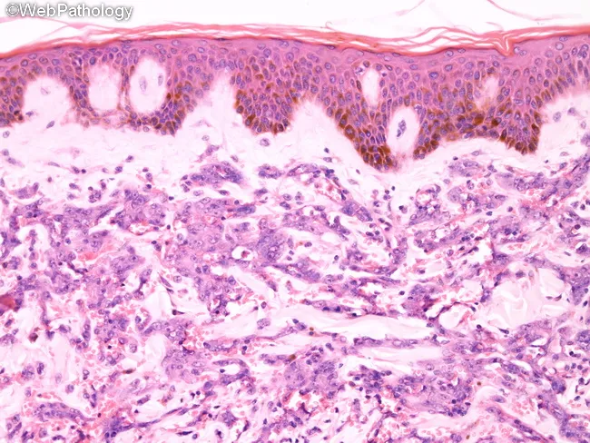 Post-radiation Angiosarcoma