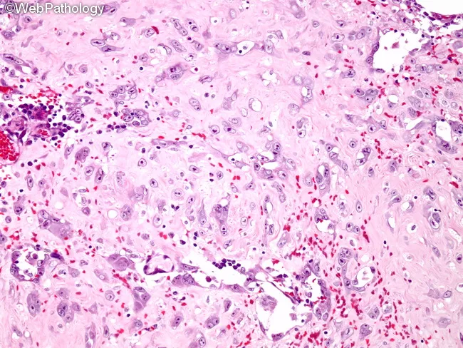 Post-radiation Angiosarcoma