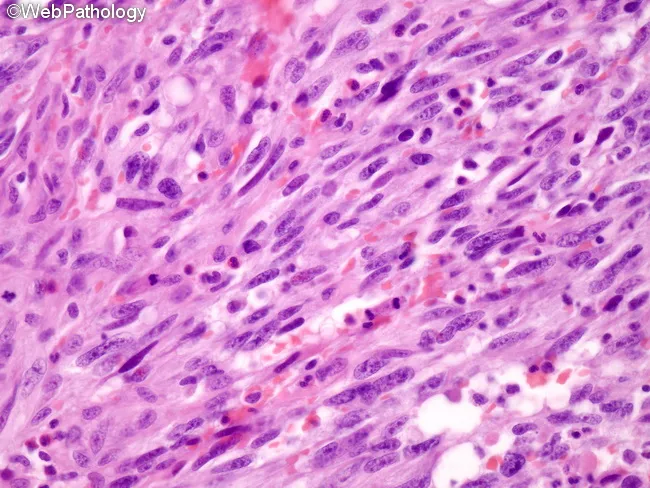 Primary Breast Angiosarcoma : Differential