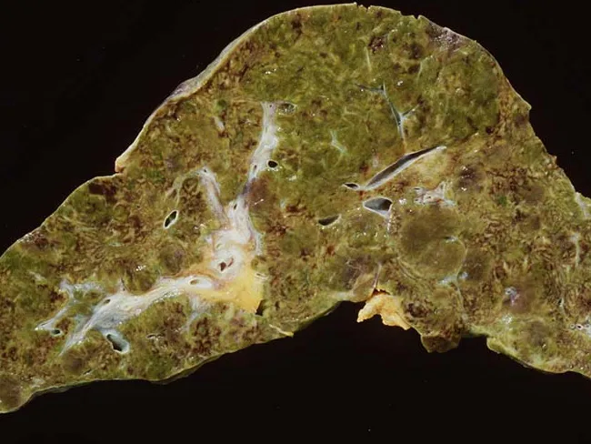 Hepatic Angiosarcoma : Introduction
