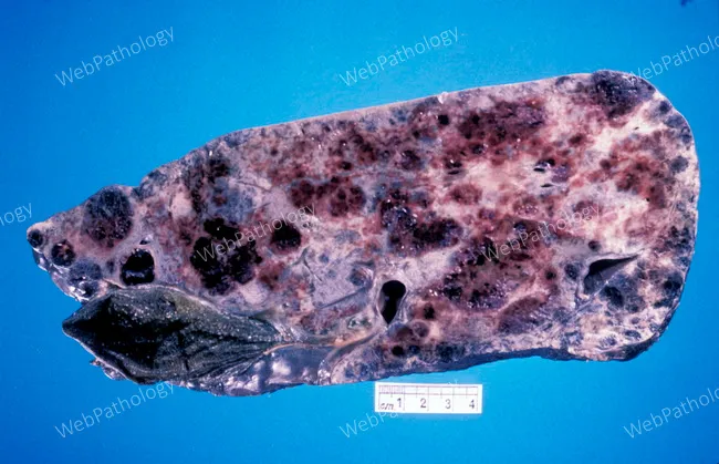 Hepatic Angiosarcoma : Clinical & Gross