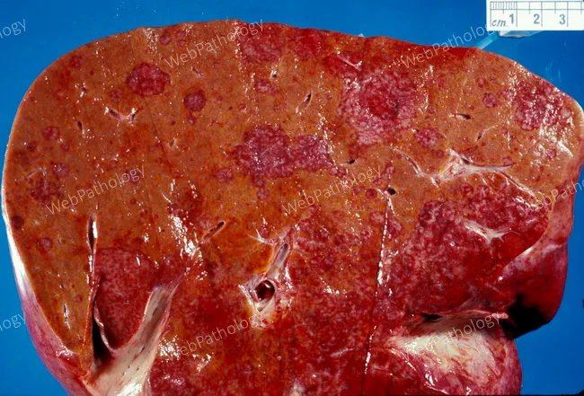 Hepatic Angiosarcoma : Gross Pathology