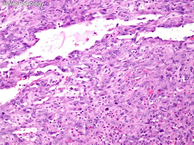 Hepatic Angiosarcoma