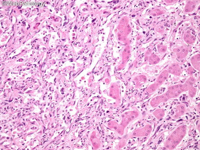 Hepatic Angiosarcoma : Liver Biopsy