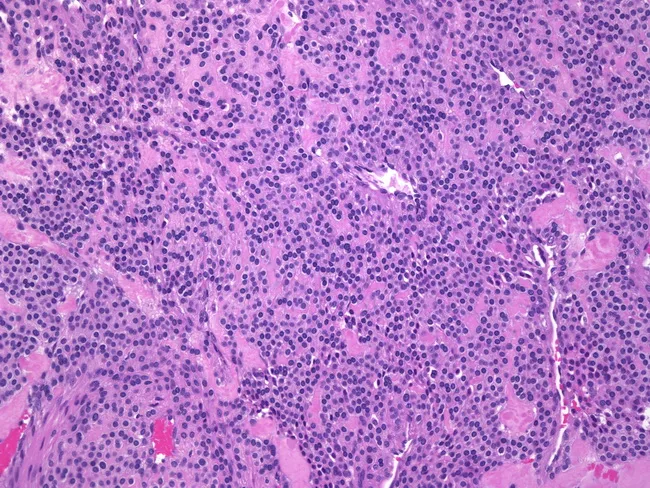 Glomus Tumor