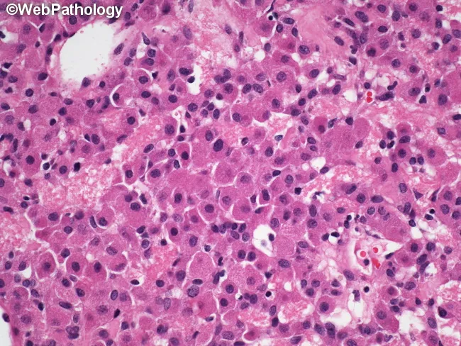 Pleomorphic Adenoma : Oncocytic Cells