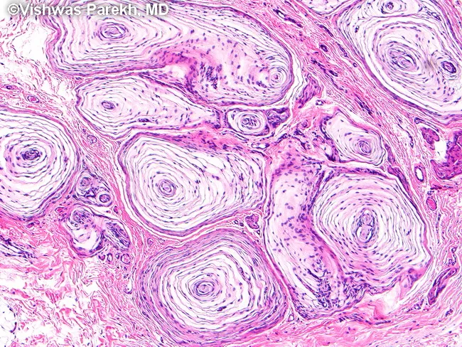 pacinian corpuscle hyperplasia