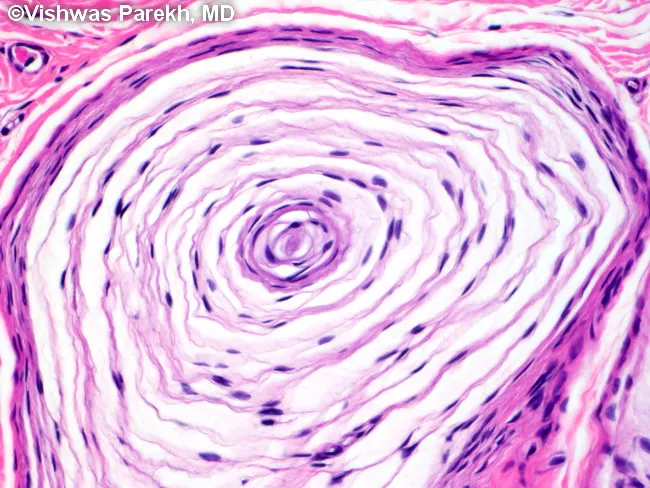 pacinian corpuscle hyperplasia