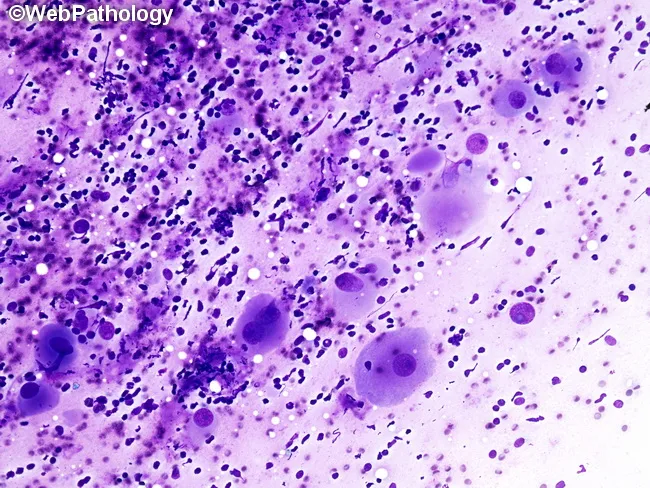 Ganglioneuroma : Touch Prep