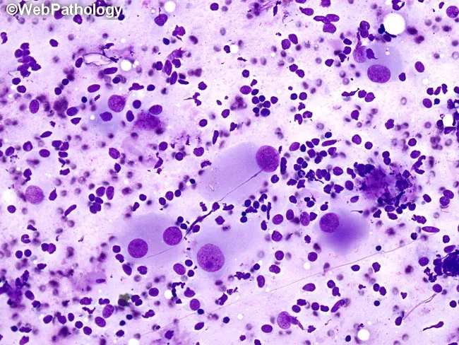 Ganglioneuroma : Touch Prep