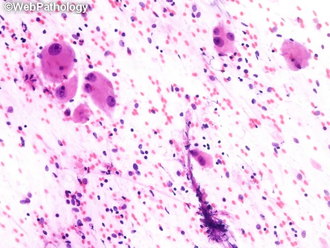 Ganglioneuroma : Touch Prep