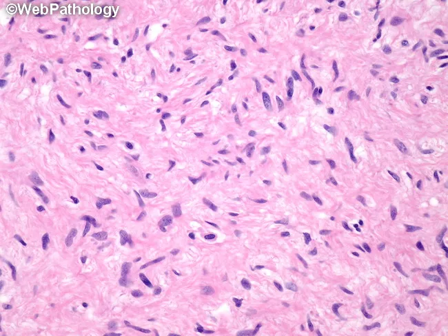 Localized Neurofibroma