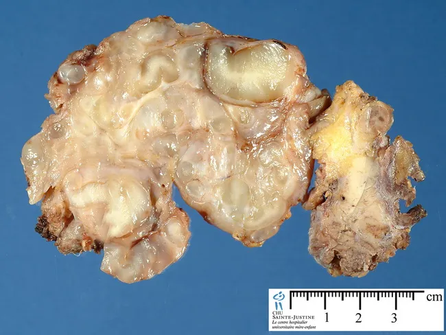 Plexiform Neurofibroma