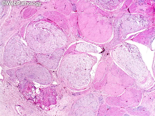Plexiform Neurofibroma
